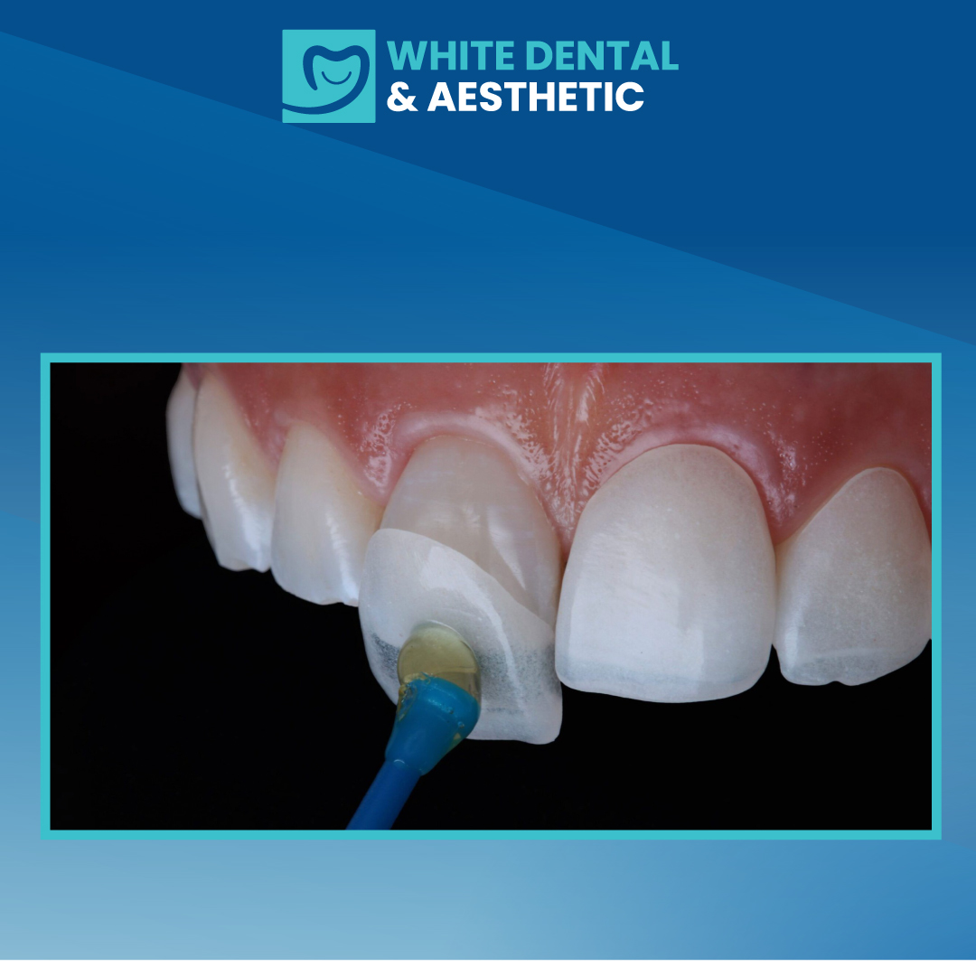 Composite Veneers - White Dental & Aesthetic